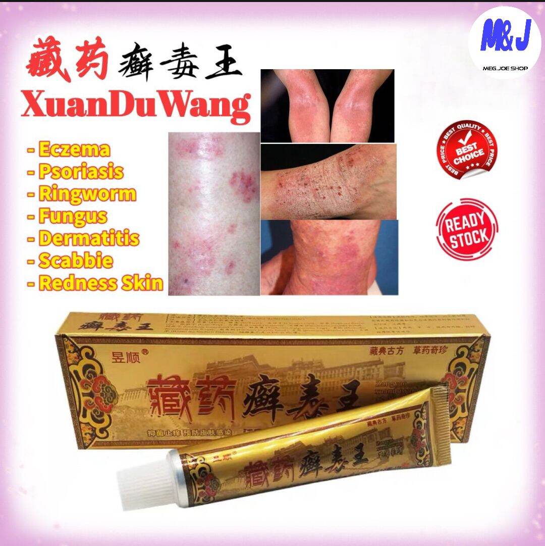 Eczema Psoriasis Beriberi Fungus Traditional Chinese Herbal Cream Ubat ...
