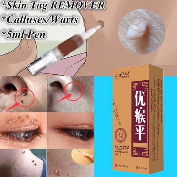 ONISEN SKIN TAG ANTIMICROBIAL SKIN CLEANCER Menghilangkan semua jenis ...