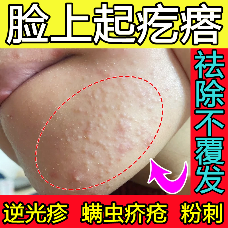 Closed Acne KILLER, Small Pimples on the Chin, Removing Facial Reverse ...