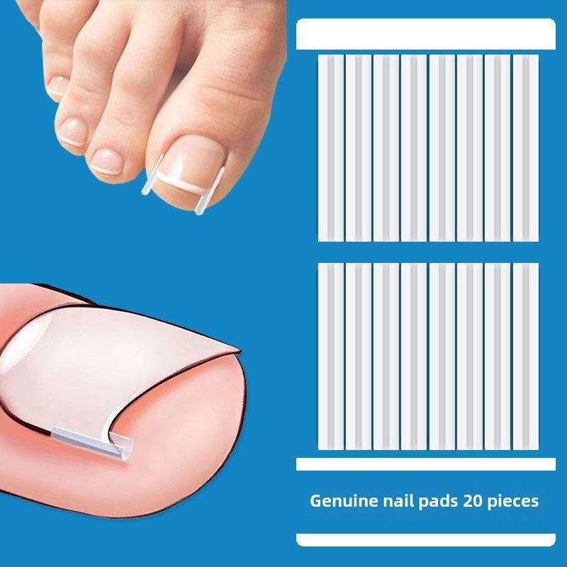 Nail Groove Handy Gadget Nail Braces Nail Inlay Special Isolation ...